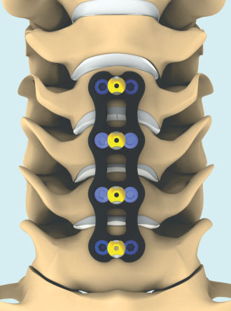 Spine Implants - Spinal Cage Mesh Pedical Screw Cervical Vertebrae ...